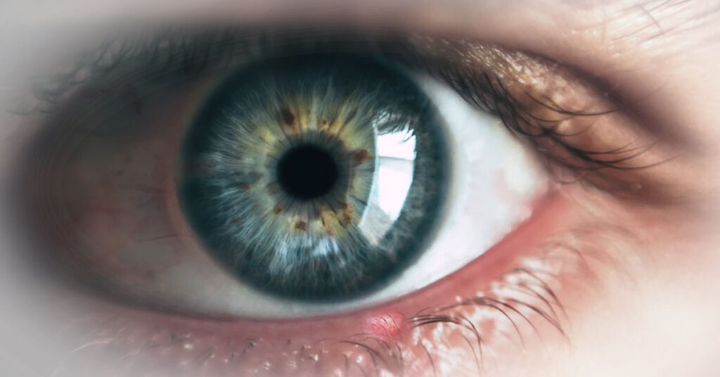 Do you ever wonder what a stye is? - Medical Outline