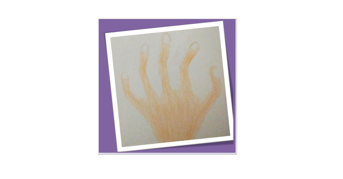 ALIEN HAND SYNDROME (AHS) - Medical Outline